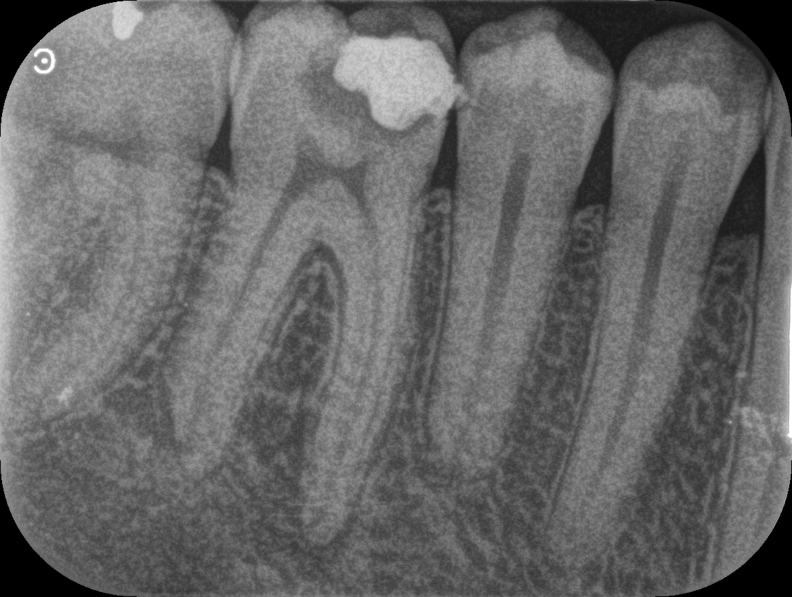 Root Canal Treatment White Gables Dental Practice 8055
